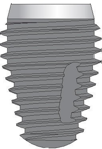 Southern Implants Promax Dental Implant | SpotImplant