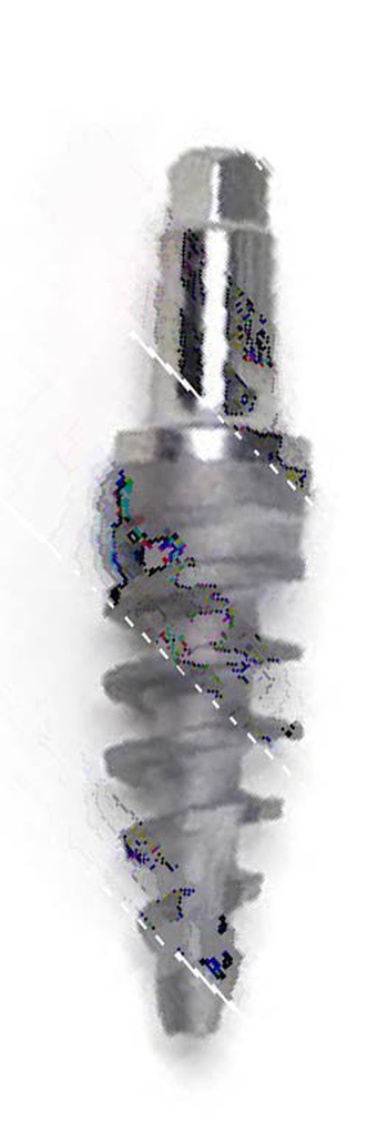 Crystal Medical Technology StableDent Ball Implant Dental Implant ...