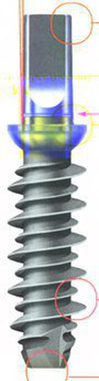 Dental implants With Revese Buttress Threads | SpotImplant