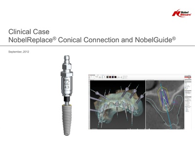 Nobel Biocare NobelReplace CC (Conical Connection) PMC Dental Implant ...