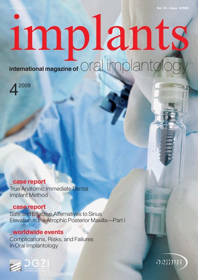 Bioimplant Implantes dentários | SpotImplant