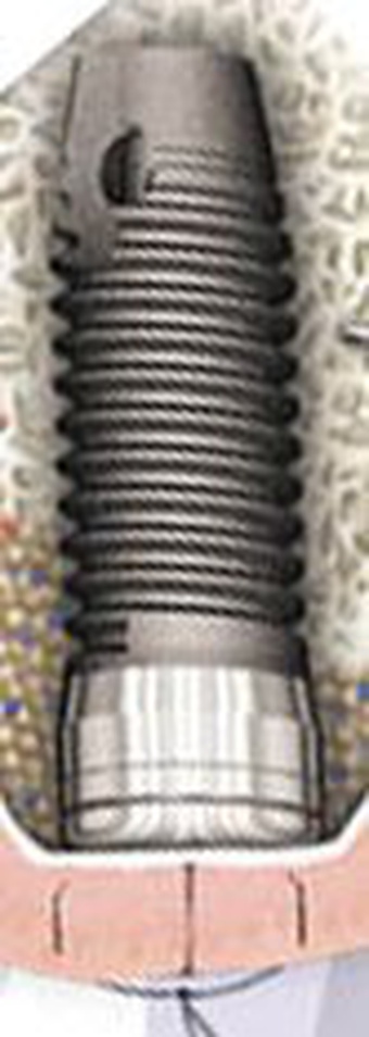 ESPE (3M) Fixture Dental Implant | SpotImplant