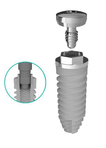 Smiletech Interna Hexagonal (HI) Dental Implant | SpotImplant