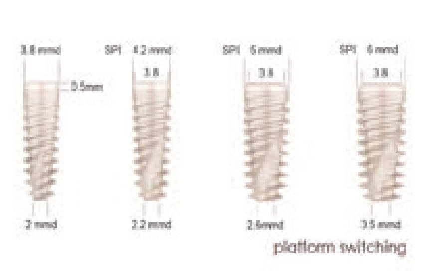 Alpha Bio Tec Spiral (SPI) Implant dentaire | SpotImplant