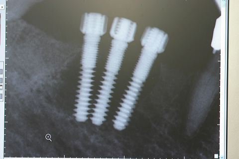 ARDS Implants Smart (Narrow) Dental Implant | SpotImplant