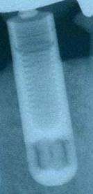 IMZ IMZ Original Zahnimplantat | SpotImplant