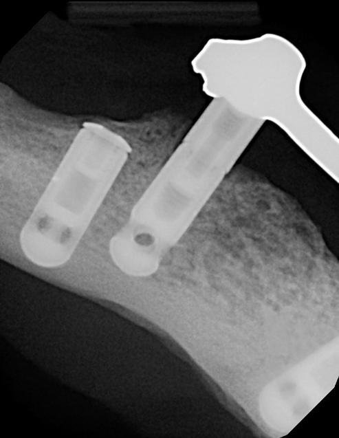 Sulzer Calcitek Integral Implant dentaire | SpotImplant
