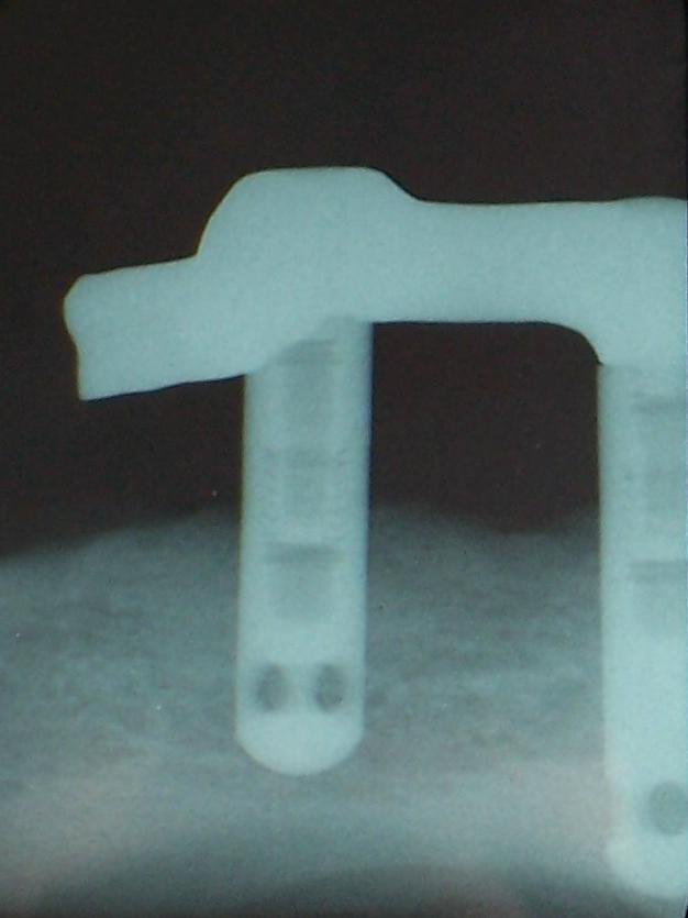 Sulzer Calcitek Integral Implant dentaire | SpotImplant