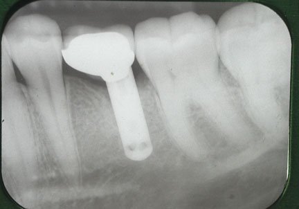 Sulzer Calcitek Omniloc Dental Implant | SpotImplant