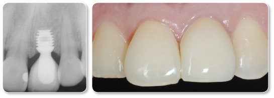 Bicon Integra-CP Implante dental | SpotImplant