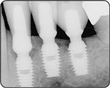 Bicon Integra-CP Implante dental | SpotImplant
