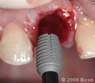 Bicon Integra-CP Implante dental | SpotImplant