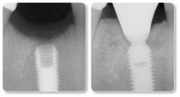 Bicon Integra-CP Implante dental | SpotImplant