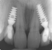 Bicon Integra-CP Implante dental | SpotImplant
