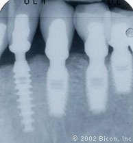 Bicon Integra-Ti Dental Implant | SpotImplant