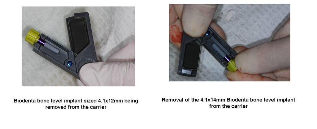 Biodenta Bone Level-BL Implant dentaire | SpotImplant