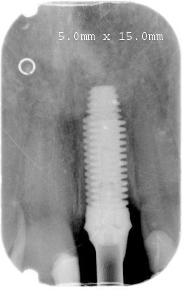 BioHorizons External Dental Implant | SpotImplant