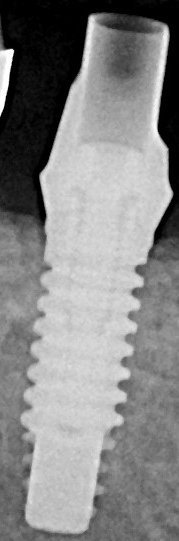 BioHorizons External (Maestro) Dental Implant | SpotImplant