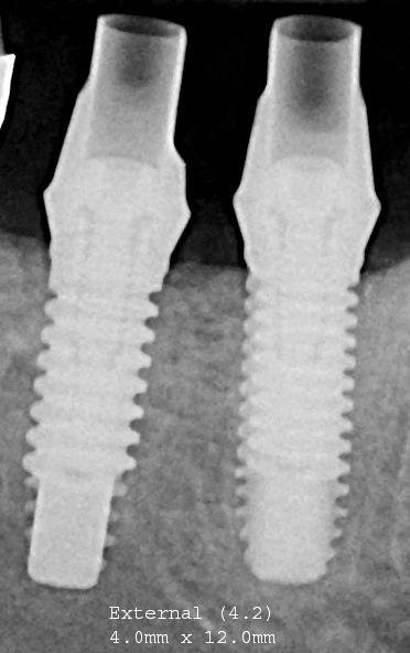 BioHorizons External (Maestro) Dental Implant | SpotImplant