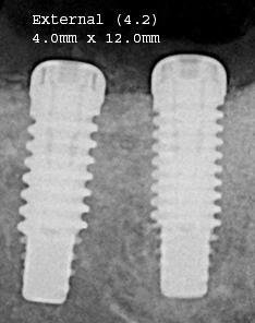 BioHorizons External (Maestro) Dental Implant | SpotImplant