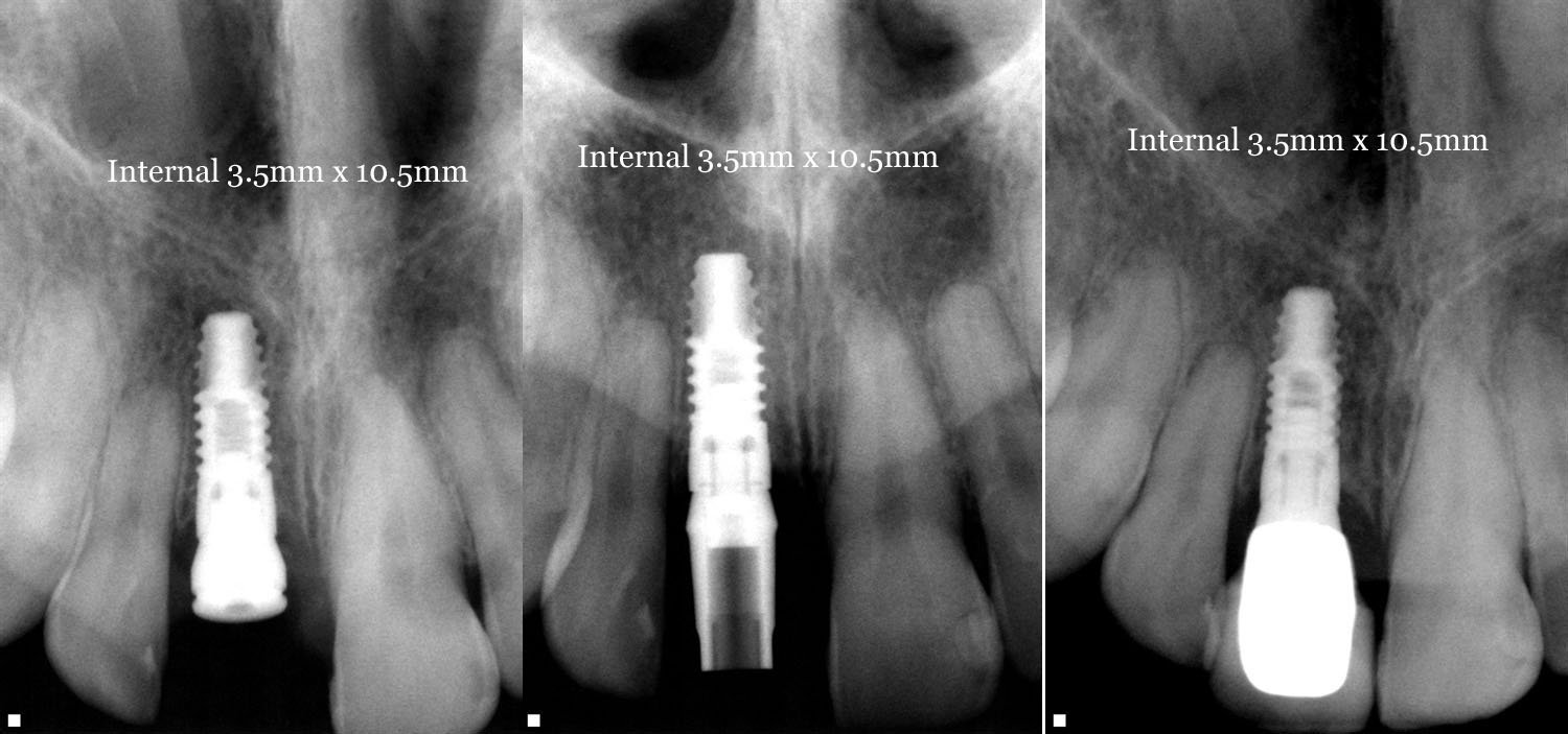 BioHorizons Internal Implante dental | SpotImplant