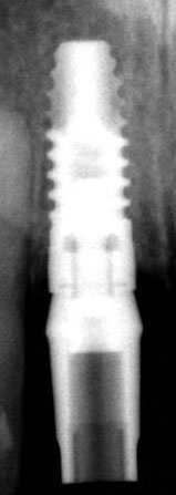 BioHorizons Internal Implante dental | SpotImplant