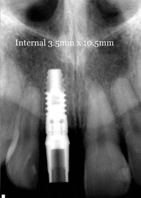 BioHorizons Internal Implante dental | SpotImplant
