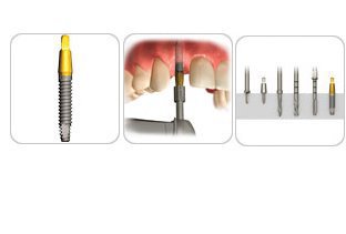 BioHorizons One Piece 3.0 Dental Implant | SpotImplant