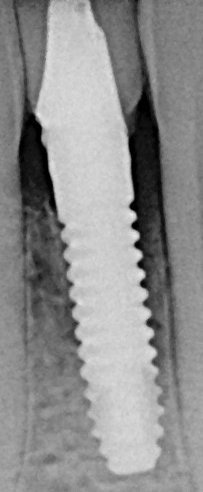 BioHorizons One Piece 3.0 Dental Implant | SpotImplant