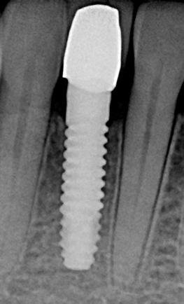 BioHorizons One Piece 3.0 Dental Implant | SpotImplant