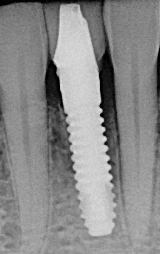 BioHorizons One Piece 3.0 Dental Implant | SpotImplant