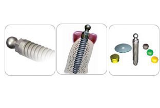 BioHorizons Overdenture Implant dentaire | SpotImplant