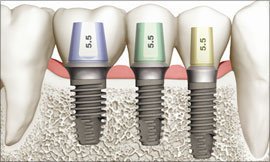 BioHorizons Single Stage Dental Implant | SpotImplant