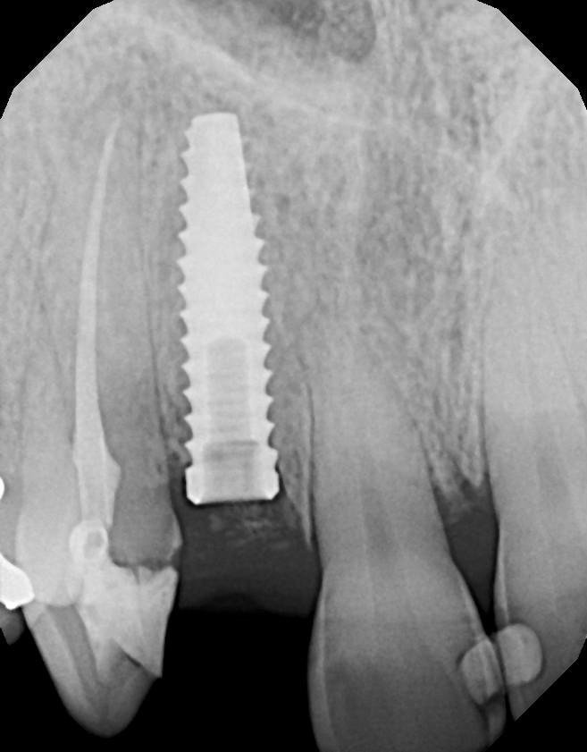 BioHorizons Tapered Internal Implant dentaire | SpotImplant