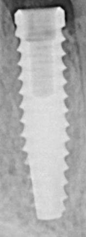 BioHorizons Tapered Internal Implant dentaire | SpotImplant