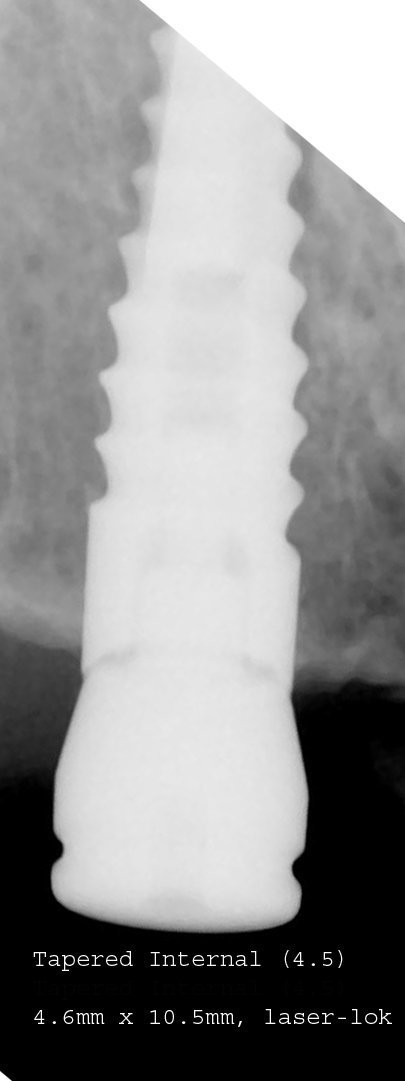 BioHorizons Tapered Internal Implant dentaire | SpotImplant