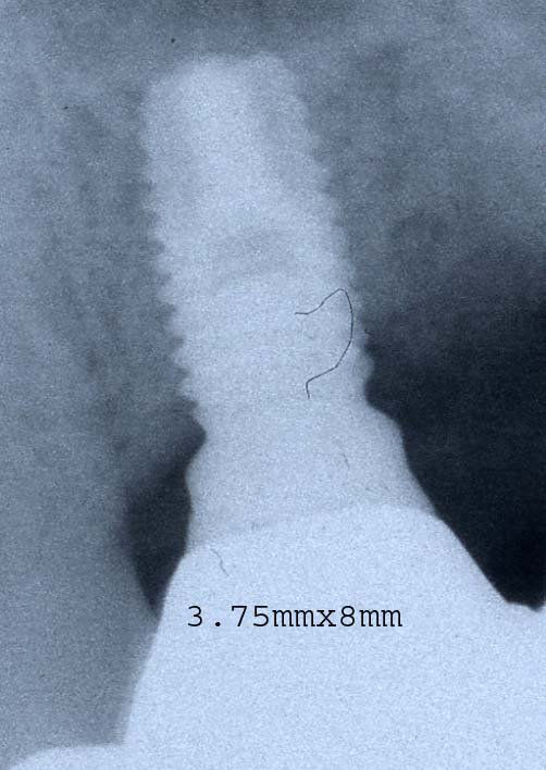 Biomet 3i Full OSSEOTITE Parallel Walled Implant dentaire | SpotImplant