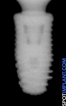 Biotech Dental Kontact Implant dentaire | SpotImplant