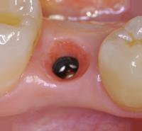 Biotech Dental Kontact Implant dentaire | SpotImplant