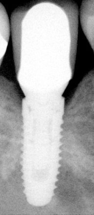 Blue Sky Bio Tri-Lobe Dental Implant | SpotImplant