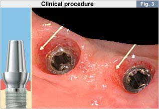 Bredent Medical Blue Sky Implant dentaire | SpotImplant