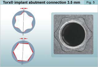 Bredent Medical Sky Classic 3.5mm Dental Implant | SpotImplant