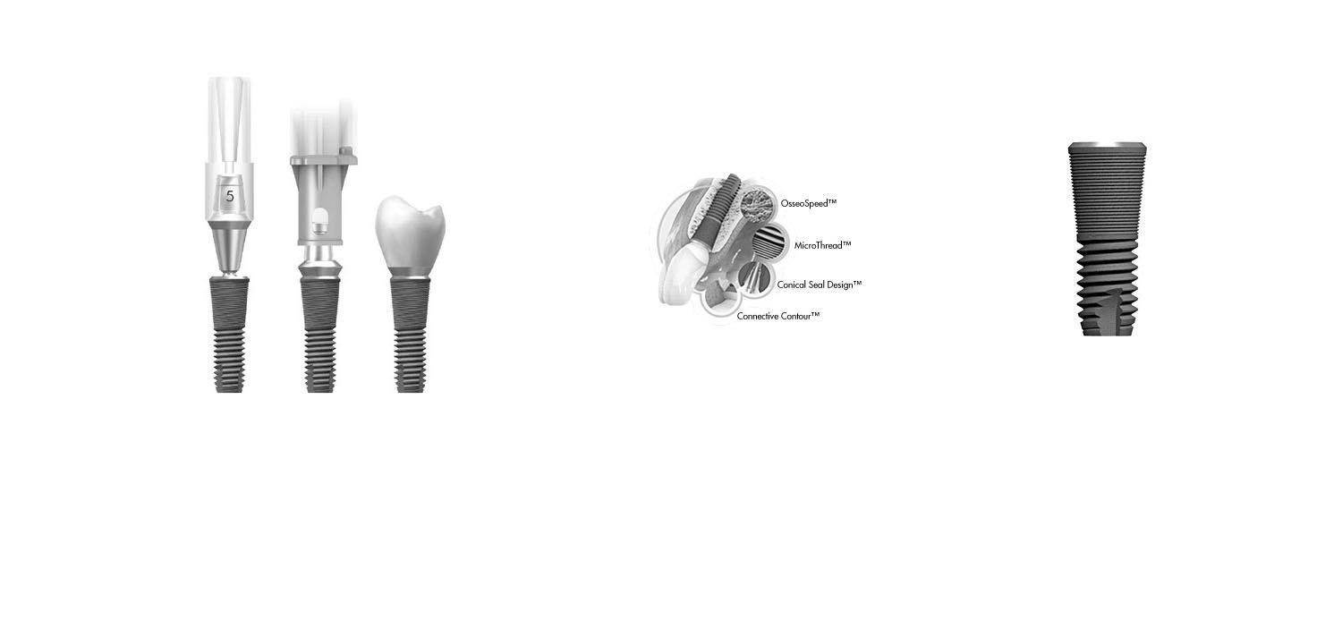 Dentsply Sirona OsseoSpeed (Astra Tech) Implant dentaire | SpotImplant