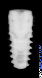 Dentsply Sirona XiVE S (Friadent) Implant dentaire | SpotImplant