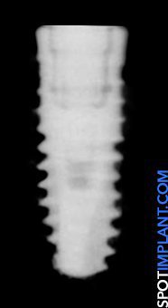 Dentsply Sirona XiVE S (Friadent) Implant dentaire | SpotImplant