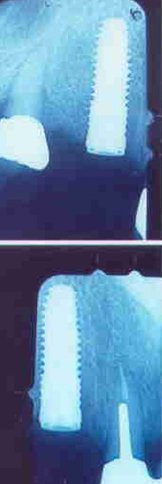 Dentsply Sirona XiVE S (Friadent) Implant dentaire | SpotImplant