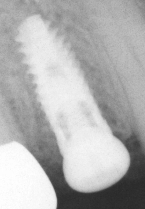Dentsply Sirona XiVE S (Friadent) Implant dentaire | SpotImplant