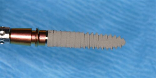 Xive Implant System From Dentsply Sirona Implants