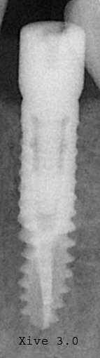 Dentsply Sirona XiVE S (Friadent) Implant dentaire | SpotImplant