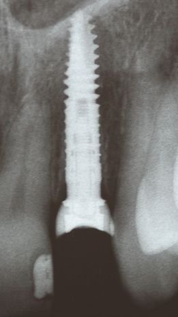 Dentsply Sirona XiVE S (Friadent) Zahnimplantat | SpotImplant